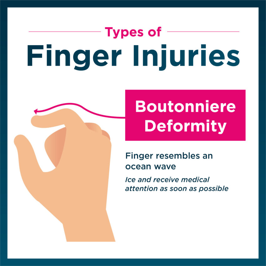 Common finger injuries: Simple strains to dislocations | Shine365