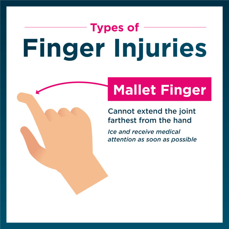 Common finger injuries: Simple strains to dislocations | Shine365