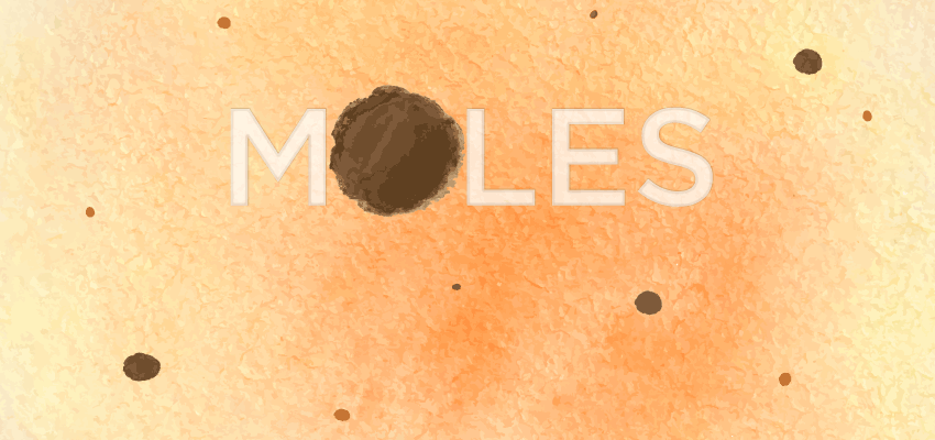 Holy moly: 5 signs of a melanoma mole | Shine365 from Marshfield Clinic
