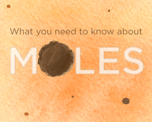 Holy moly: 5 signs of a melanoma mole | Shine365 from Marshfield Clinic