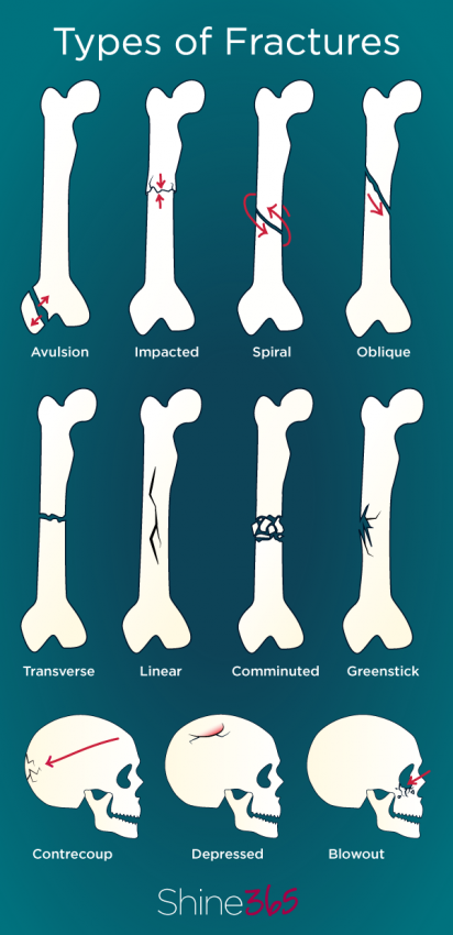 Your Most Common Broken Bone Questions Answered