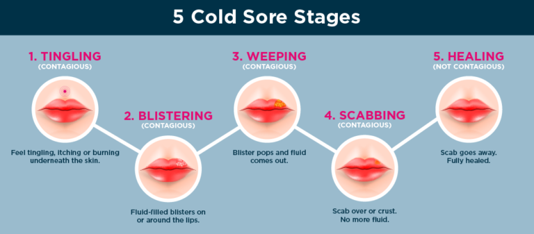 Cold sores are contagious until fully healed | Shine365 from Marshfield ...
