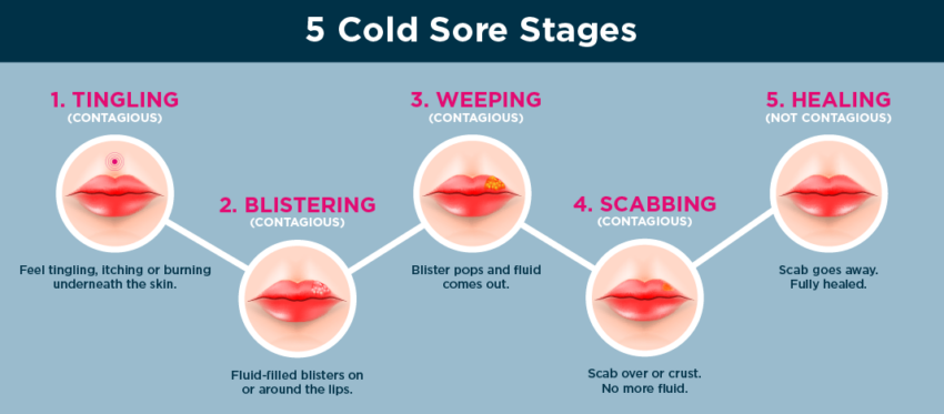 Cold sores are contagious until fully healed | Shine365 from Marshfield ...