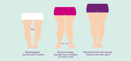 When to worry about bowlegs in toddlers and growing children